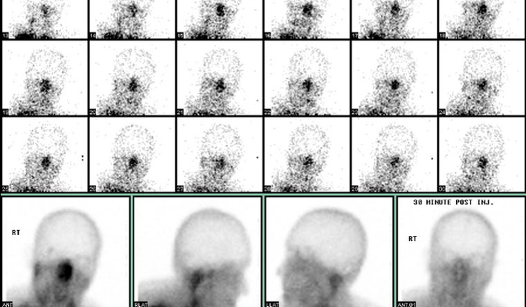 Demystifying brain death- The Week