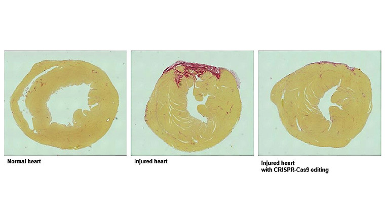 Is it possible to recover from a severe heart attack?- The Week