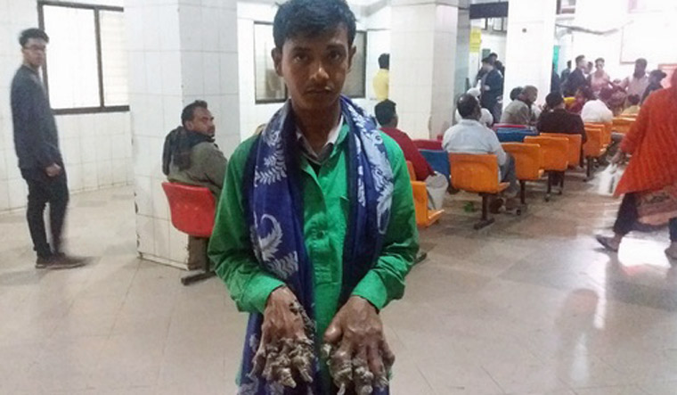 Bangladeshi 'Tree Man' dreams of cure as rare skin disease returns- The ...